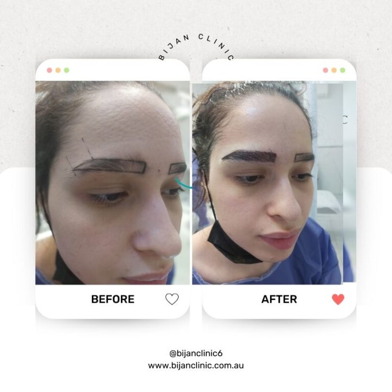 Hair Transplant & Eyebrow Specialists in Australia | Bijanclinic