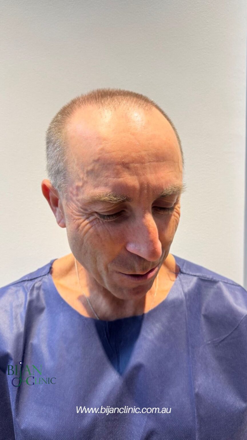 Before and after FUE hair transplant | Bijanclinic